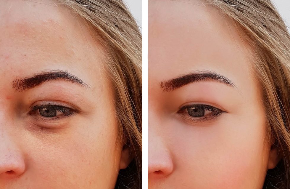 Podočnjaci uzrok - podocnjaci.hr