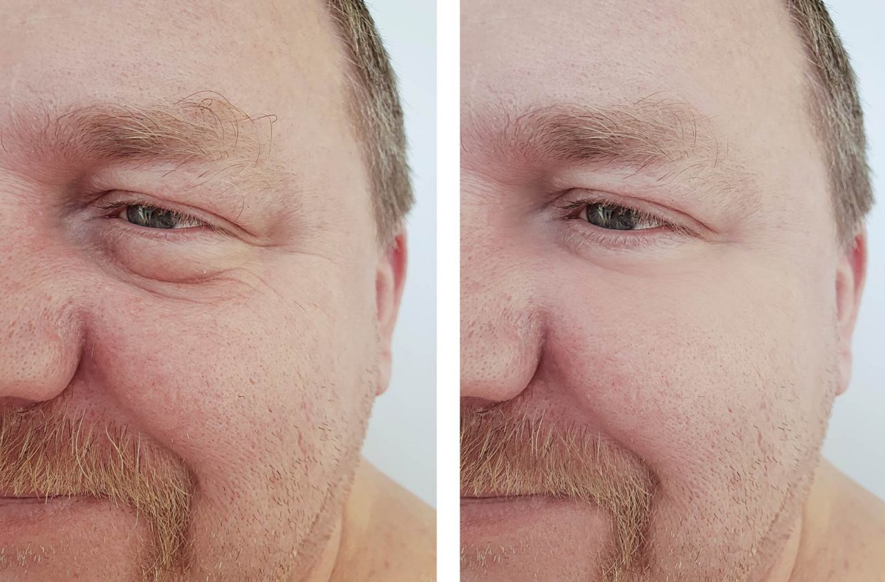 Podočnjaci od sinusa - podocnjaci.hr